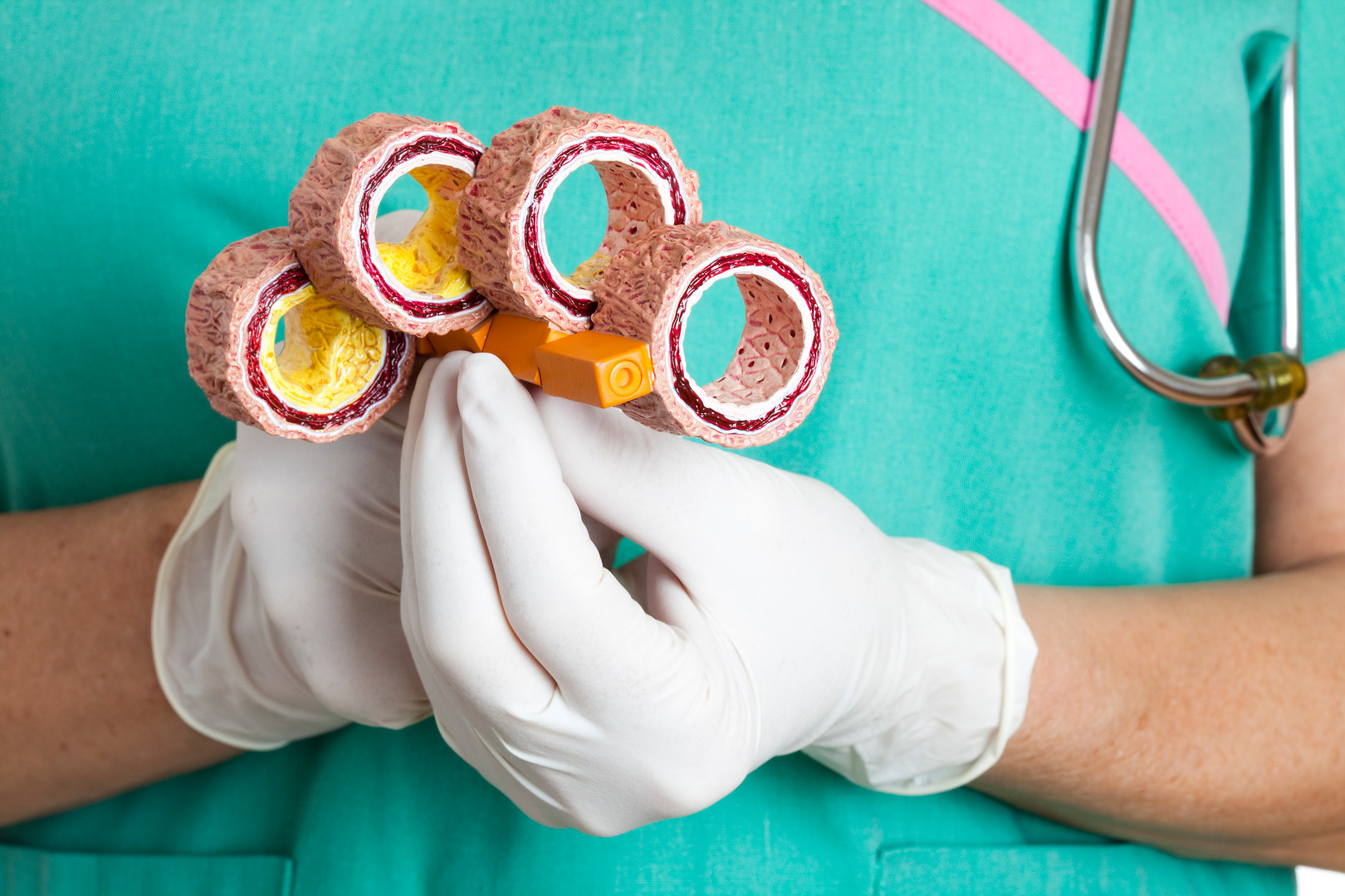 Nieuw consortium voor persoonlijke behandeling bij slagaderverkalking ...