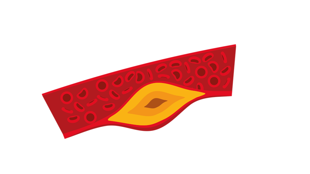 Alles over slagaderverkalking | Hartstichting