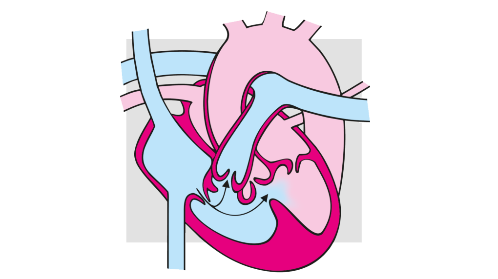 Tetralogie van Fallot | Hartstichting