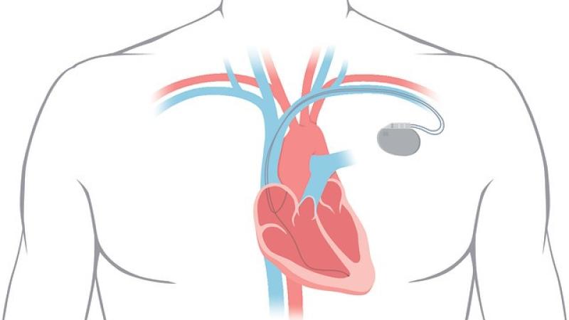 Eventrecorder bij hart- en vaatziekten | Hartstichting