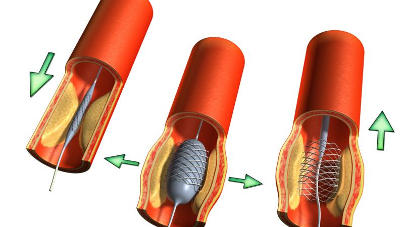 behandeling vernauwde beenslagader | Hartstichting